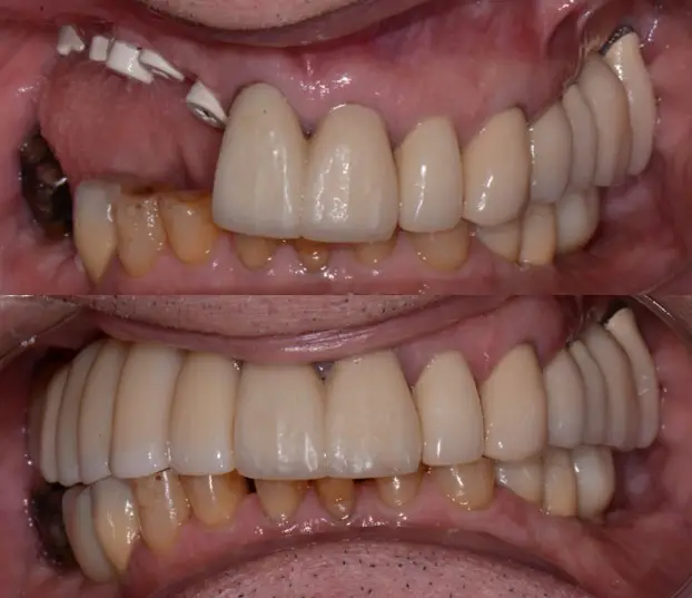 Ceramic Implants | Sussex & Warren County’s Leading Dentist | Dr. Ewa ...