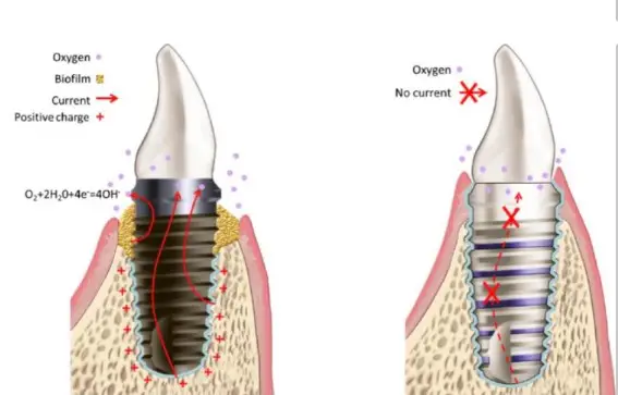 Ceramic Implants | Sussex & Warren County’s Leading Dentist | Dr. Ewa ...